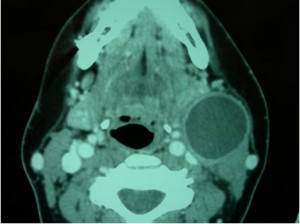 Neck Lumps - ENT Clinic