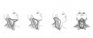 Neck Dissection - ENT Clinic
