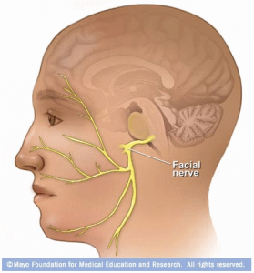 Bell's Palsy - Facial Nerve Disorders