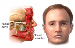 Symptoms and Treatment for Facial Nerve Damage - ENT Clinic Sydney
